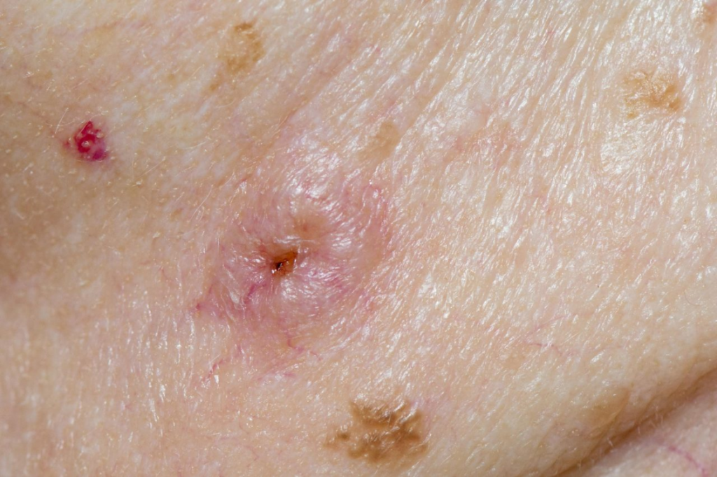 About Skin Cancer - The Skin Cancer Practice - Types Of Skin Cancer